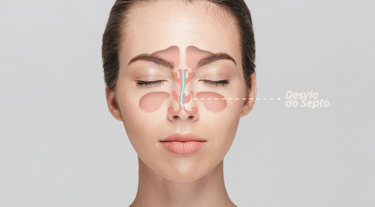 Cirurgia de desvio de septo: Saiba o que é verdade e o que é mito